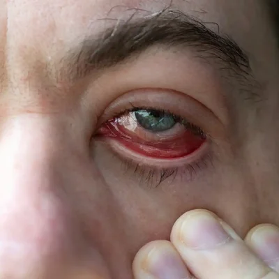 Remedios caseros y naturales para aliviar los ojos rojos | Noticias RCN