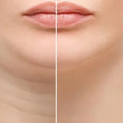 ¿Cómo eliminar la papada de manera rápida y sencilla? Métodos caseros ...